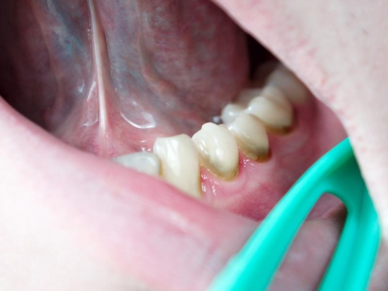 ¿Cuáles son las enfermedades bucales más comunes? - Clínica Dental De ...